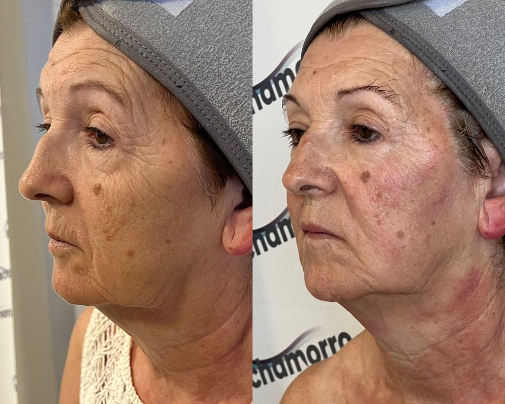 Lifting sin cirugía