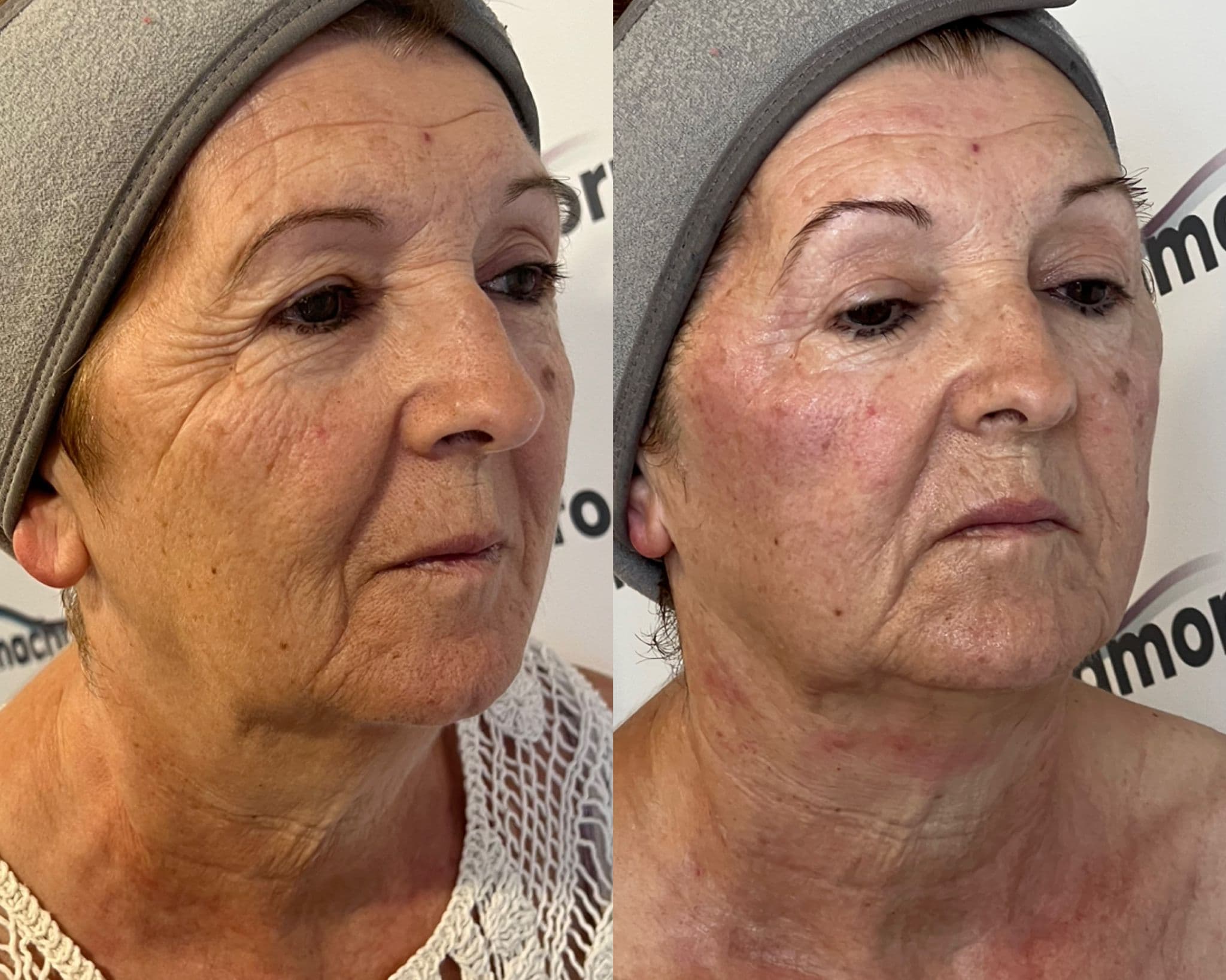 Lifting sin cirugía