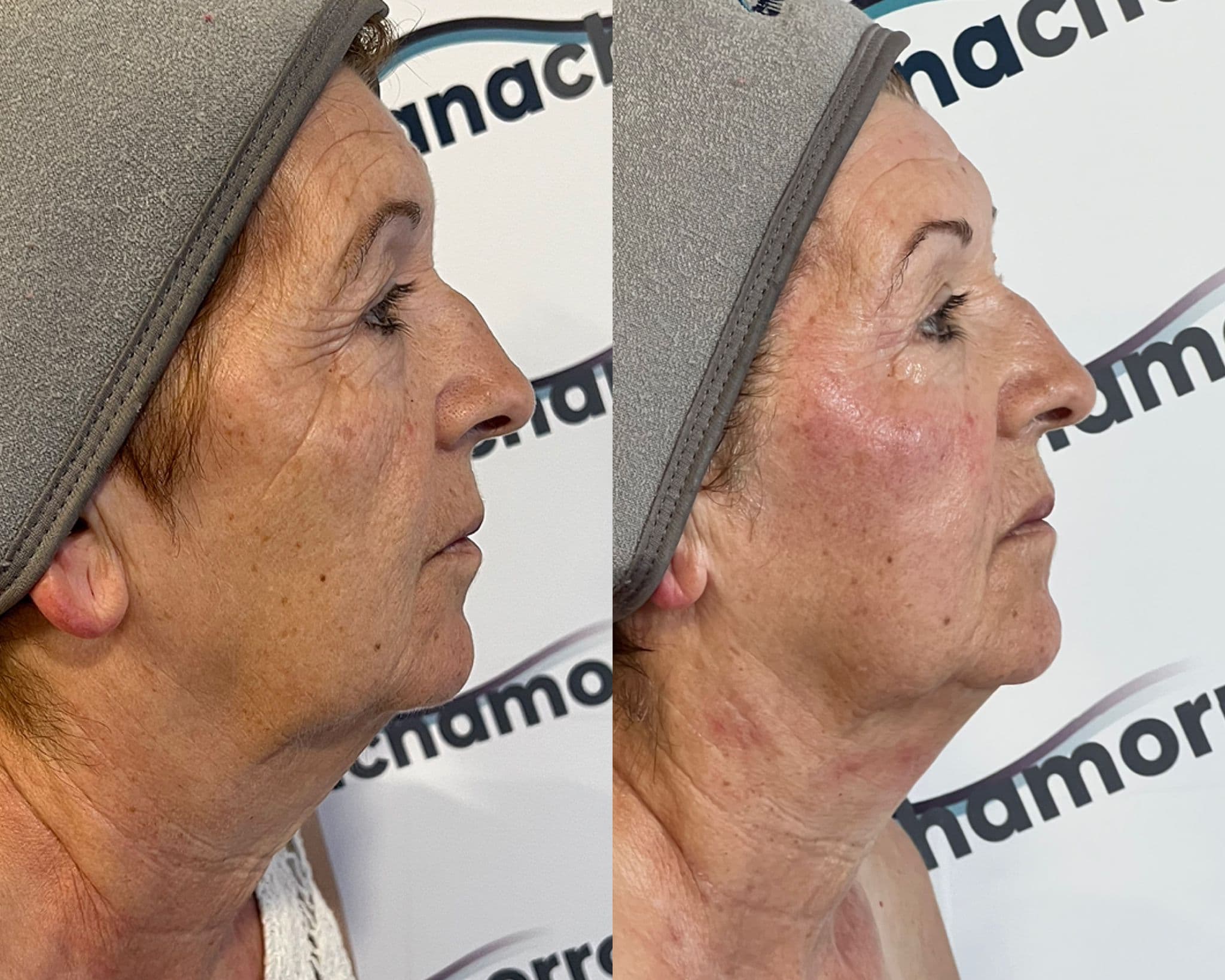 Lifting sin cirugía